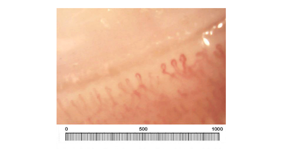 Nail Fold Capillaries