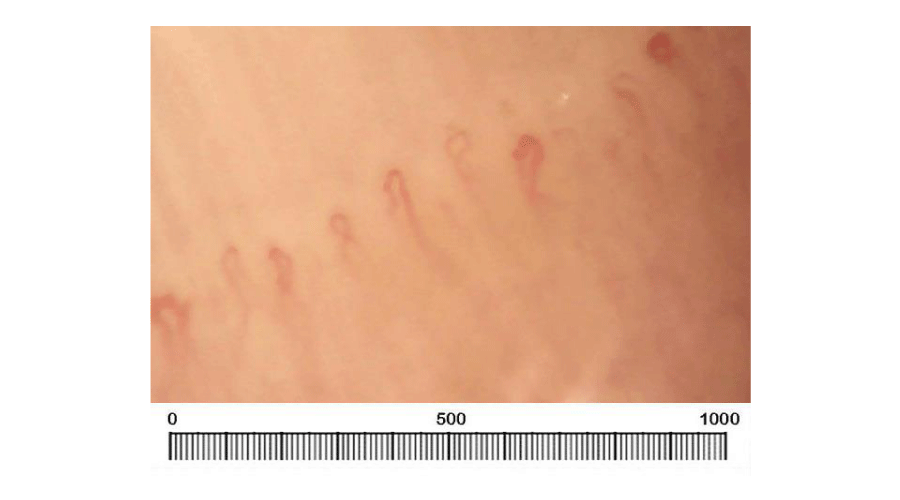 Nail Fold Capillaries