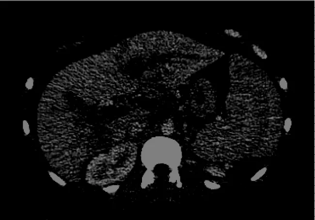 Ileocecal Valve Location