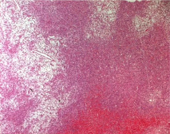 Mitotically active fibrothecoma in association with sclerous peritonitis