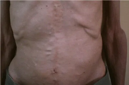 Three decades of survival in Pancreatic Neuroendocrine Tumor with ...