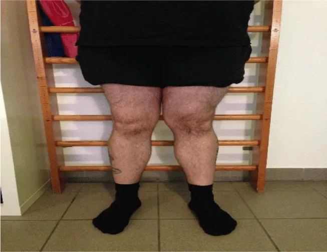 Patella Alta in a Patient with Recurrent Patellar Dislocation