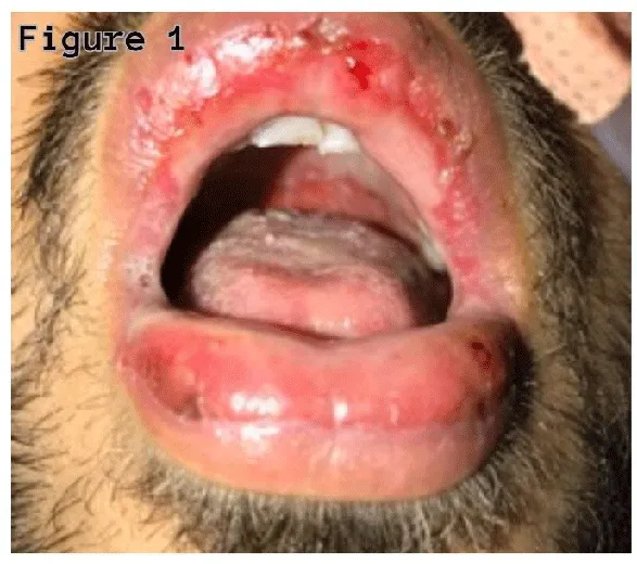 Mycoplasma pneumoniae-induced rash and mucositis: A rare extrapulmonary ...