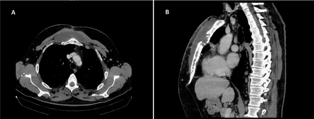 Seroma after sternal wound debridement: Case report