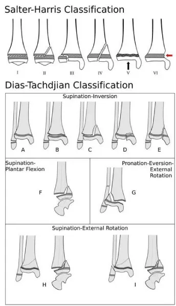 Ankle Fractures in Children